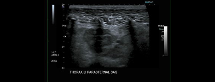 Ultraschalldiagnostik des Thorax - Webseminar und Handout
